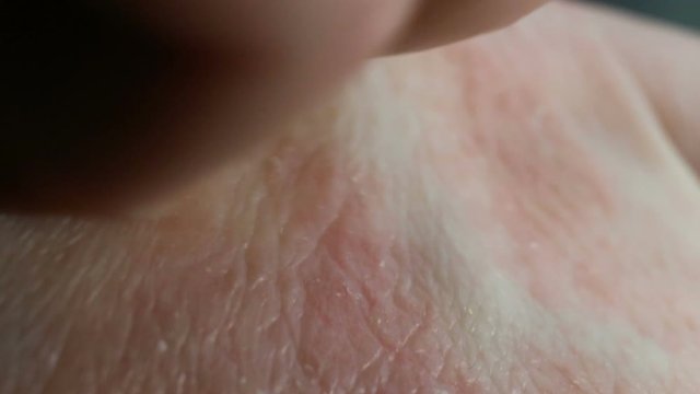 Dermatographism Images – Browse 204 Stock Photos, Vectors, and Video ...