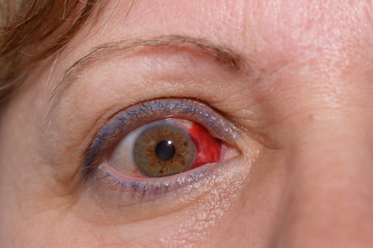 Bindehautsack Bilder – Durchsuchen 1,531 Archivfotos, Vektorgrafiken ...