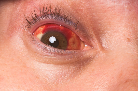 Bindehautsack Bilder – Durchsuchen 1,582 Archivfotos, Vektorgrafiken ...