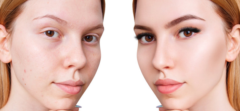 Pimples Images – Browse 231,934 Stock Photos, Vectors, and Video ...