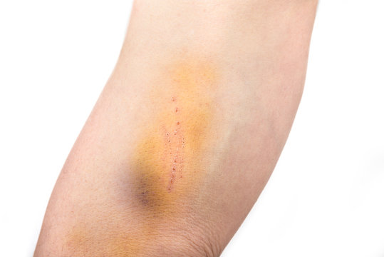 Blue(Bruise) Images – Browse 3,789 Stock Photos, Vectors, and Video ...