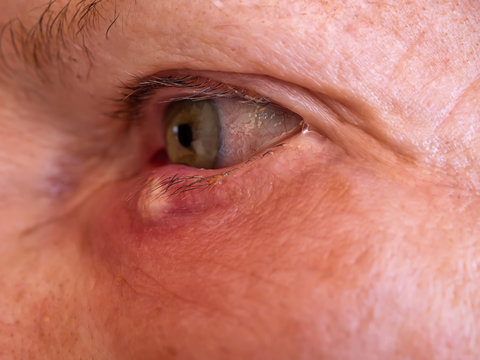 Blefarit bilder – Bläddra bland 1,184 stockfoton, vektorer och videor ...