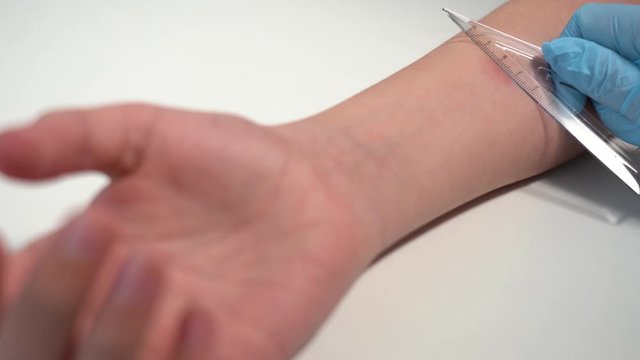 "Mantoux Test" Images – Browse 202 Stock Photos, Vectors, and Video ...