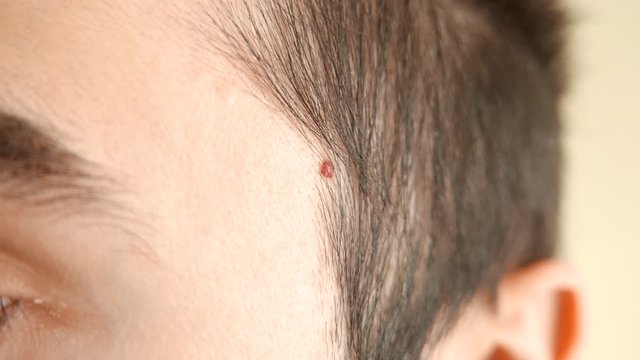 Cherry Angioma On Scalp