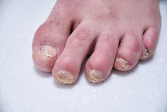 Onycholyse Bilder – Durchsuchen 526 Archivfotos, Vektorgrafiken und ...