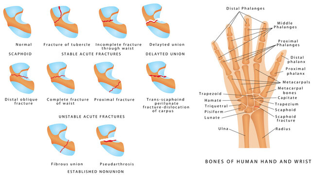 Scaphoid Fracture Types