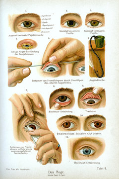 Bindehautsack Bilder – Durchsuchen 1,280 Archivfotos, Vektorgrafiken ...
