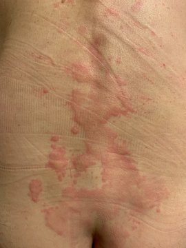 Nesselsucht Images – Browse 82 Stock Photos, Vectors, and Video | Adobe ...