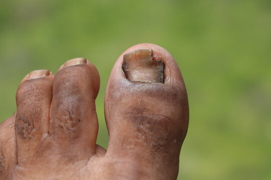 48 BEST Panaritium IMAGES, STOCK PHOTOS & VECTORS | Adobe Stock