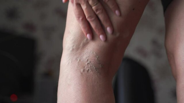 Lipodermatosclerosis Images – Browse 86 Stock Photos, Vectors, and ...