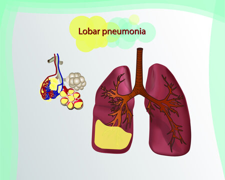 Lobar Pneumonia