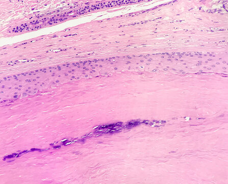 Atherom Bilder – Durchsuchen 2,570 Archivfotos, Vektorgrafiken und ...