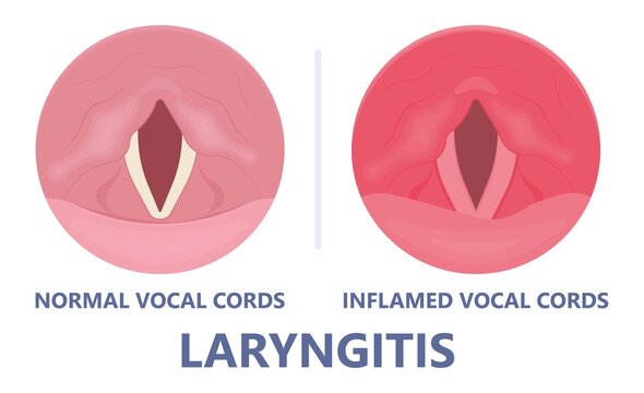 Laryngitis Images – Browse 2,548 Stock Photos, Vectors, and Video ...