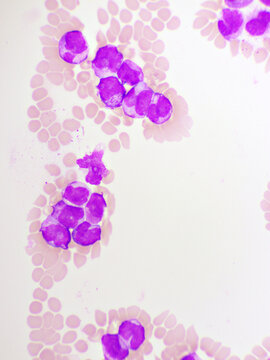 Leukemia Bilder – Durchsuchen 16,372 Archivfotos, Vektorgrafiken und ...