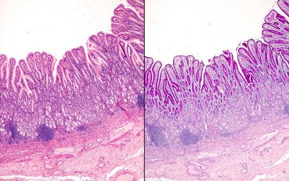 รูปภาพPyloric – เลือกดูภาพถ่ายสต็อก เวกเตอร์ และวิดีโอ1,255 | Adobe Stock