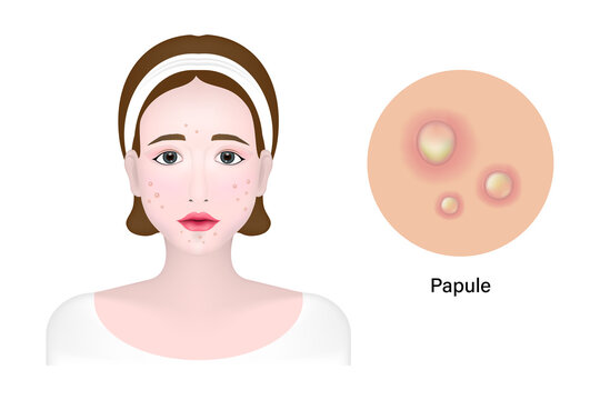 รูปภาพPapule – เลือกดูภาพถ่ายสต็อก เวกเตอร์ และวิดีโอ3,666 | Adobe Stock