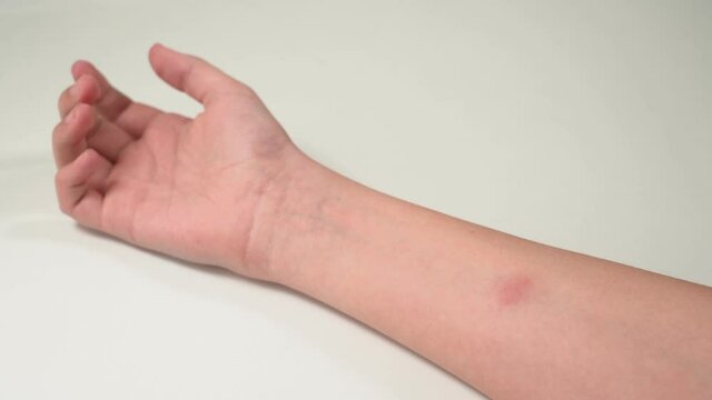 "Mantoux Test" Images – Browse 244 Stock Photos, Vectors, and Video ...