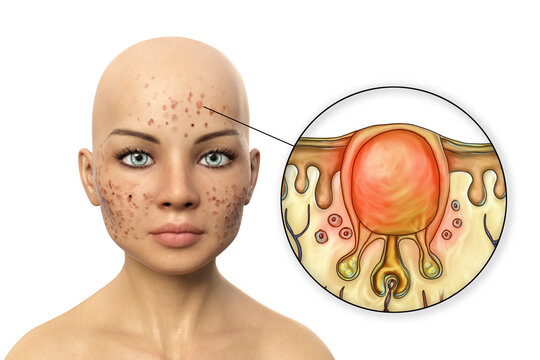 Imagens de Microcomedones – Explore Fotografias do Stock, Vetores e ...
