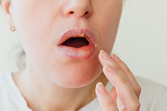 "Blisters Crust" Images – Browse 108 Stock Photos, Vectors, and Video ...