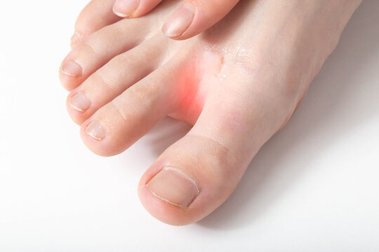 Intertrigo Images – Browse 57 Stock Photos, Vectors, and Video | Adobe ...