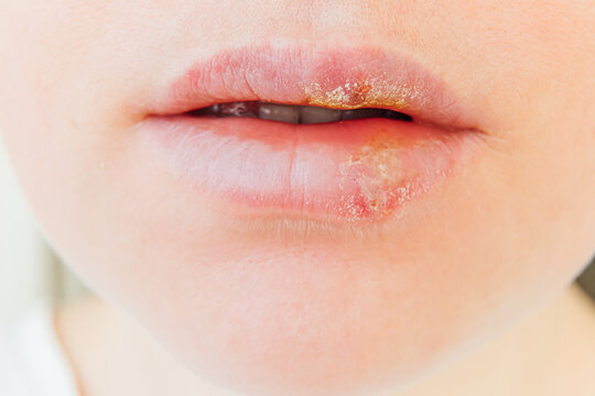 "Blisters Crust" Images – Browse 108 Stock Photos, Vectors, and Video ...