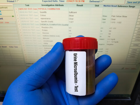 Microalbumin Images – Browse 18 Stock Photos, Vectors, and Video ...