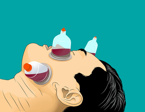 Cupping Therapy Face Images – Browse 2,674 Stock Photos, Vectors, and ...