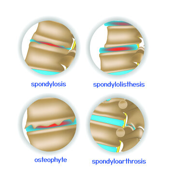 Osteophyte Images – Browse 823 Stock Photos, Vectors, and Video | Adobe ...