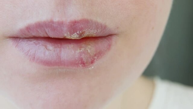 "Blisters Crust" Images – Browse 130 Stock Photos, Vectors, and Video ...