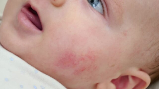 「Baby Pimples」の写真素材 | 2,855件の無料イラスト画像 | Adobe Stock