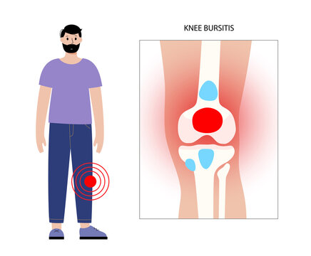 รูปภาพSuprapatellar – เลือกดูภาพถ่ายสต็อก เวกเตอร์ และวิดีโอ61 | Adobe ...