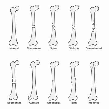 Comminuted Fracture Diagram