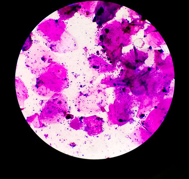 Staphylococcus Aureus Gram Stain 100x