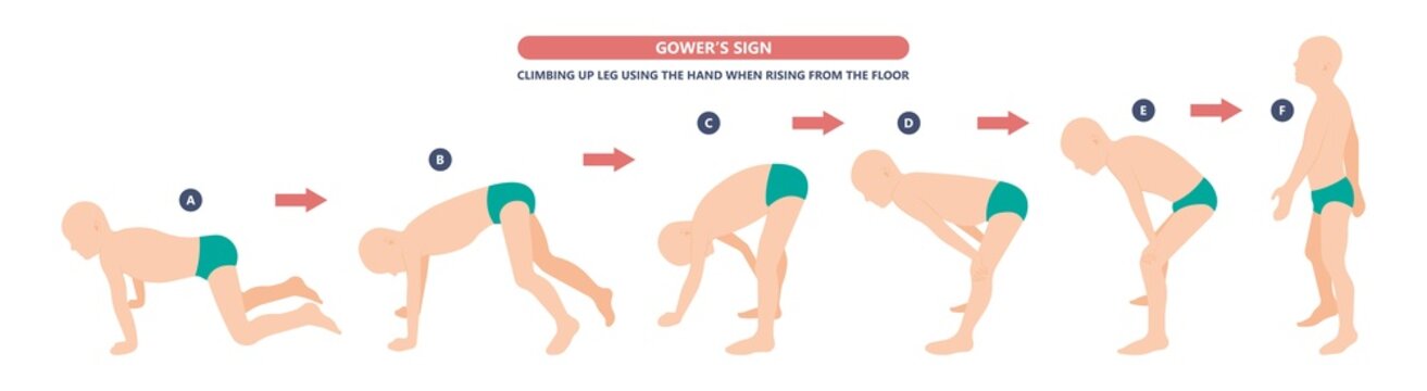 Gowers Sign