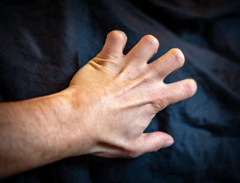 Palmaris Longus Test