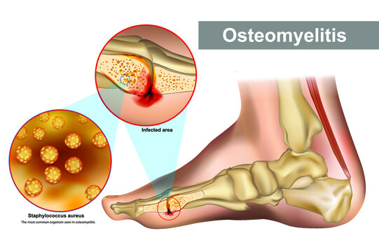 รูปภาพOsteomyelitis – เลือกดูภาพถ่ายสต็อก เวกเตอร์ และวิดีโอ4,599 ...