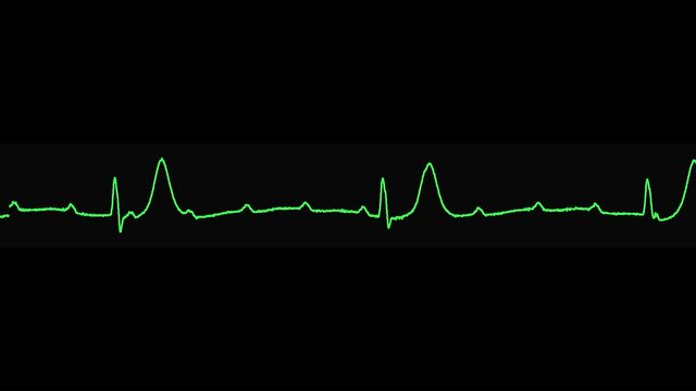 Third Degree Heart Block Animation
