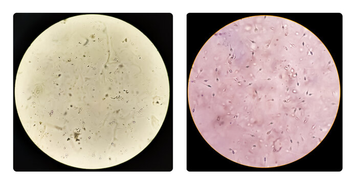 Azoospermia Images – Browse 210 Stock Photos, Vectors, and Video ...