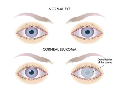 รูปภาพLeucoma – เลือกดูภาพถ่ายสต็อก เวกเตอร์ และวิดีโอ451 | Adobe Stock