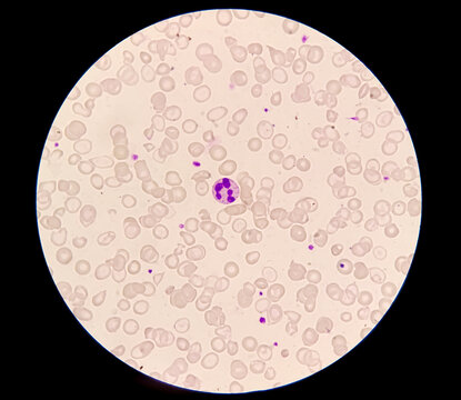Ovalocytes Images – Browse 74 Stock Photos, Vectors, and Video | Adobe ...
