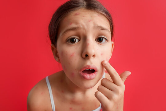 Waterpox Bilder – Durchsuchen 102 Archivfotos, Vektorgrafiken und ...