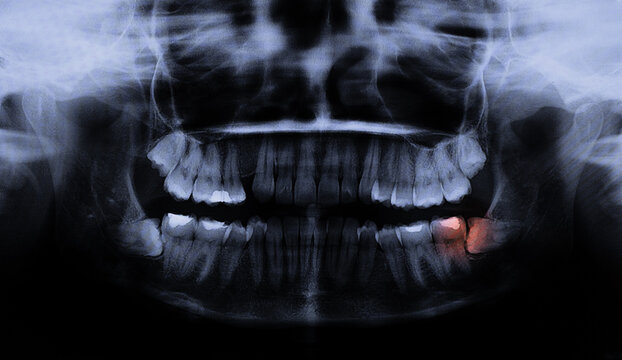 รูปภาพ"Teeth Xray" – เลือกดูภาพถ่ายสต็อก เวกเตอร์ และวิดีโอ65 | Adobe Stock