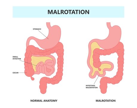รูปภาพMegacolon – เลือกดูภาพถ่ายสต็อก เวกเตอร์ และวิดีโอ129 | Adobe Stock