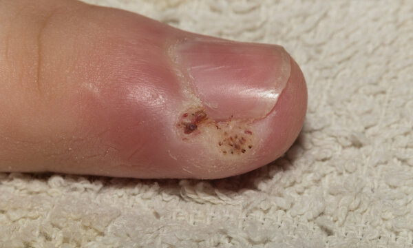 Panaricium - Images et vidéos libres de droits | Adobe Stock