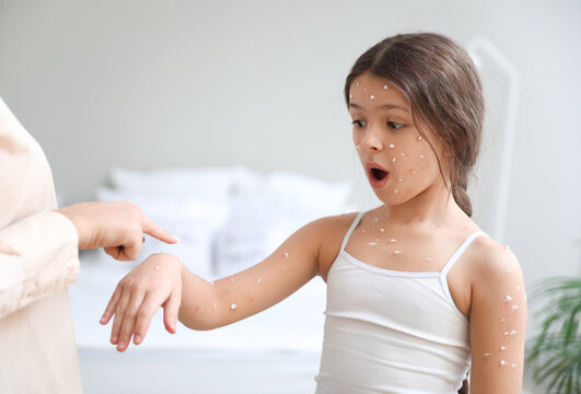 Imagens de Waterpox – Explore Fotografias do Stock, Vetores e Vídeos de ...