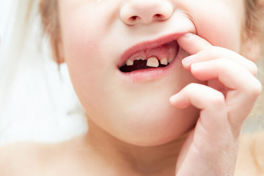 Milchgebiss Bilder – Durchsuchen 22,483 Archivfotos, Vektorgrafiken und ...