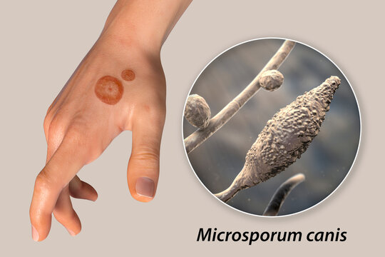 Dermatophytic bilder – Bläddra bland 1,180 stockfoton, vektorer och ...