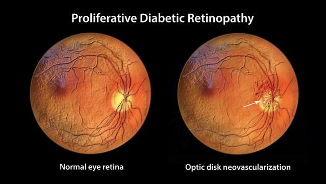 Neovascularization Of The Disc