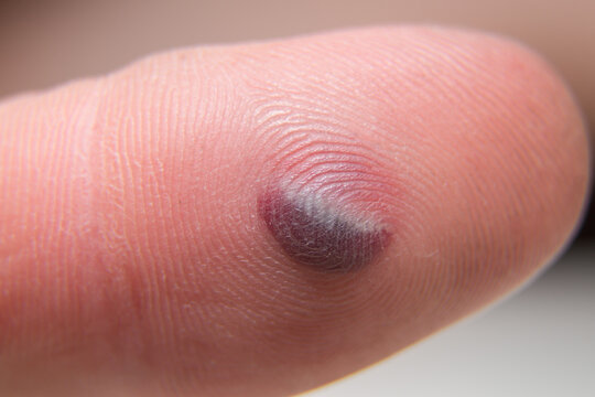 Pinched Skin Bruise Bruise On Leg Images – Browse 12,921 Stock