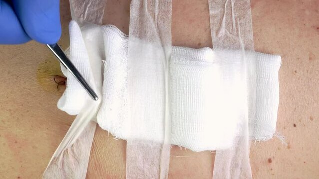 Suture Video Footage – Browse 2,640 HD Stock Video and Footage | Adobe ...